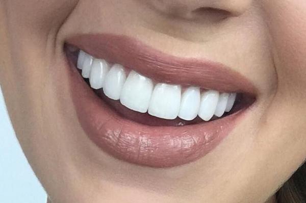 Full Mouth Restoration — Kemptville Smiles Dentistry | Family ...