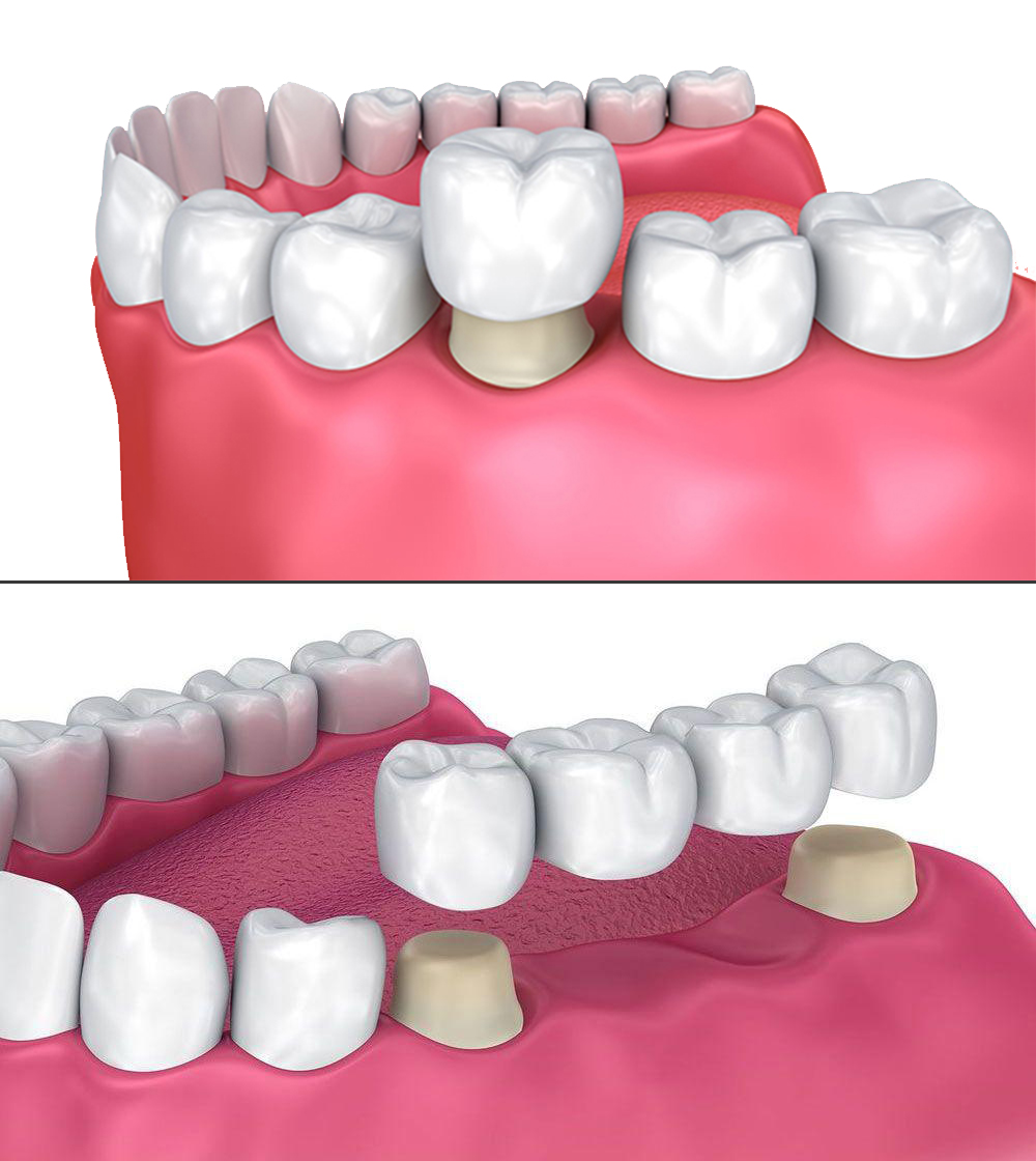 Crowns And Bridges | Malton, ON Dentist | Westwood Dental